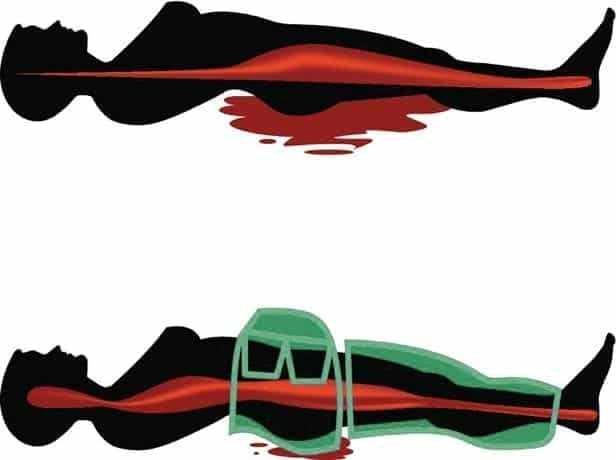 Non-Pneumatic Anti-Shock Garments (NASG) - VIA Global Health