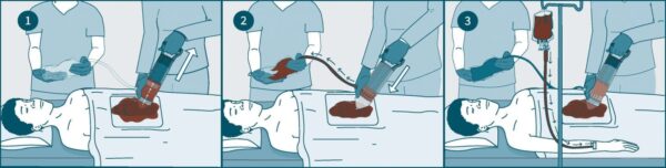 Buy the HEMAFUSE® Pump with 25 Filters and Accessory Kits VIA Global Health